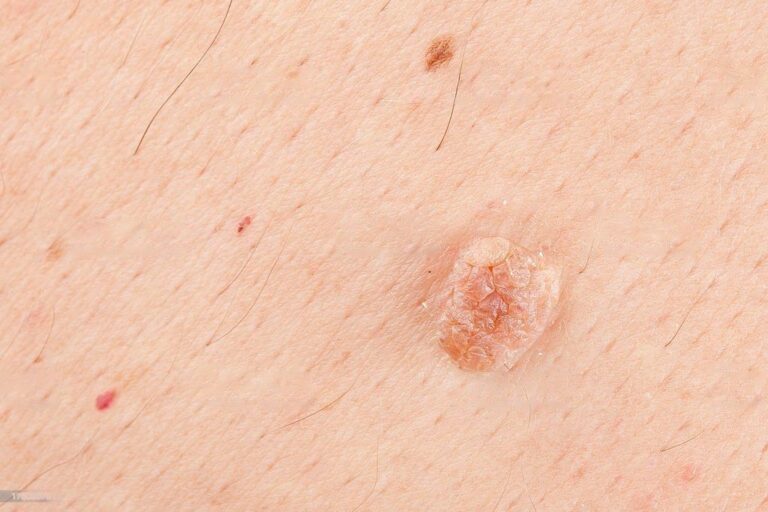 Wart Removal Treatment In Bangalore Cost Procedure Vitalsklinic